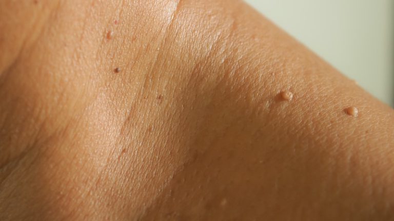 Skin Tags: Causes, Risks, and Removal | Seniors Guide